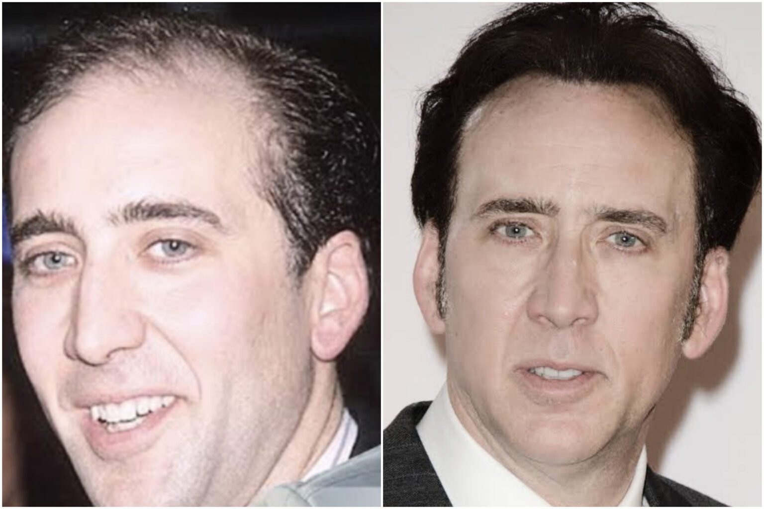 Hollywood Celebrity Hair Transplant Analysis - Alloroots